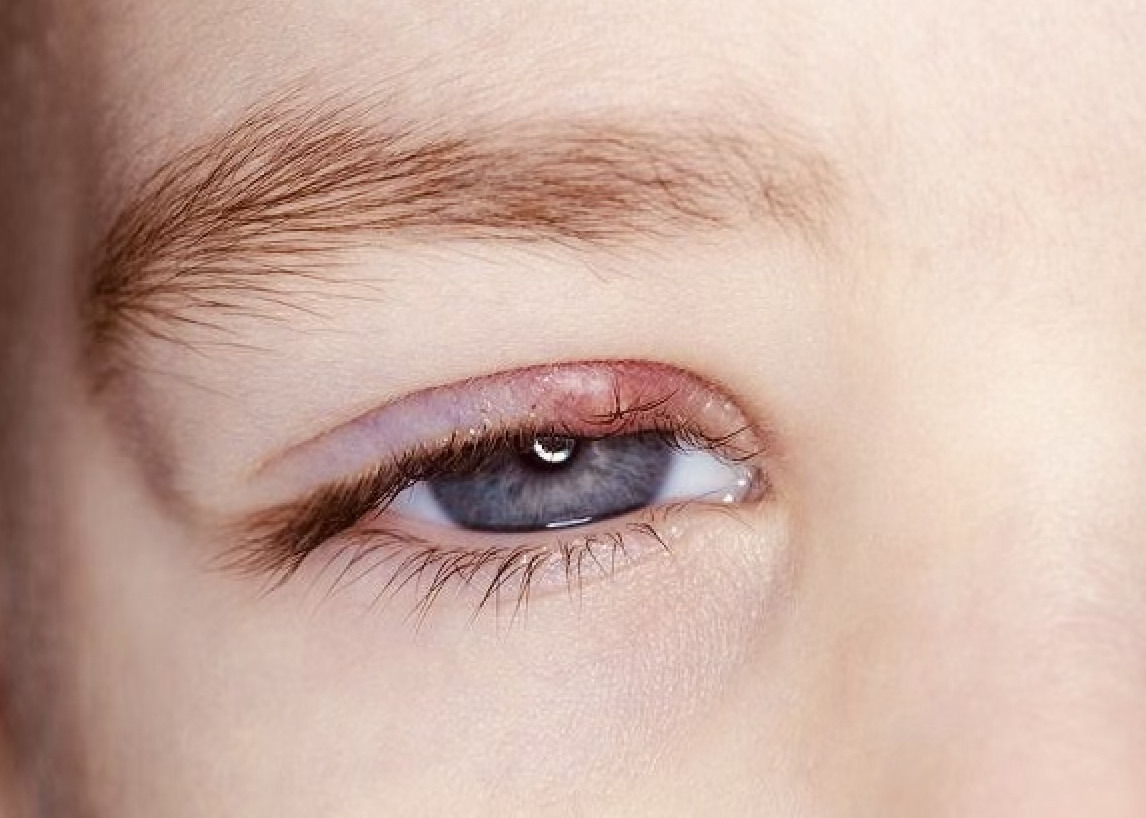 Eye Stye – Treatments, Symptoms and What Causes It? – Stye (sty ...